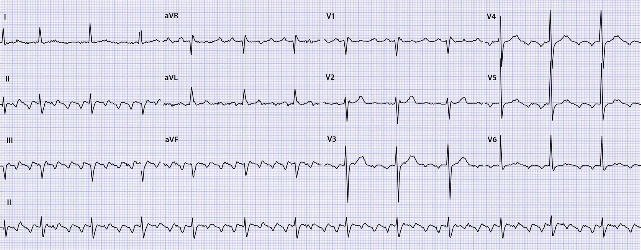 Ecg