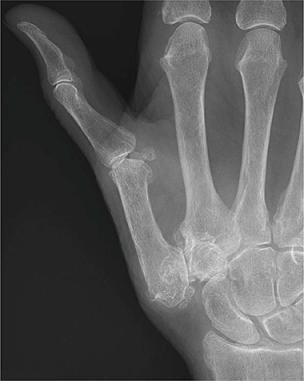 Kennistoets Duimbasisartrose | H&W