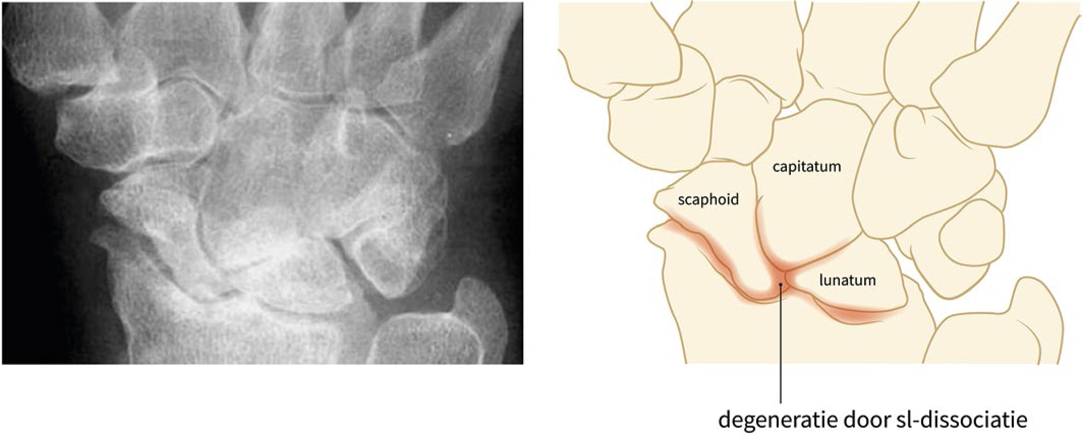 Een pijnlijke pols na een val | H&W
