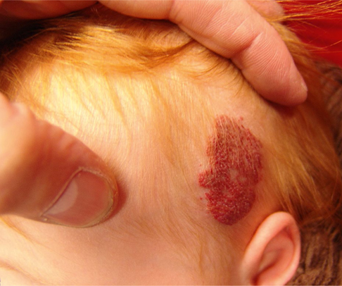 Infantiel hemangioom | H&W