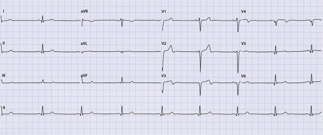 Ecg-casus ‘Dubbele diagnose’ | H&W