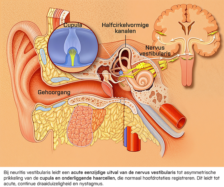 BPPD of neuritis vestibularis: herken het verschil | H&W