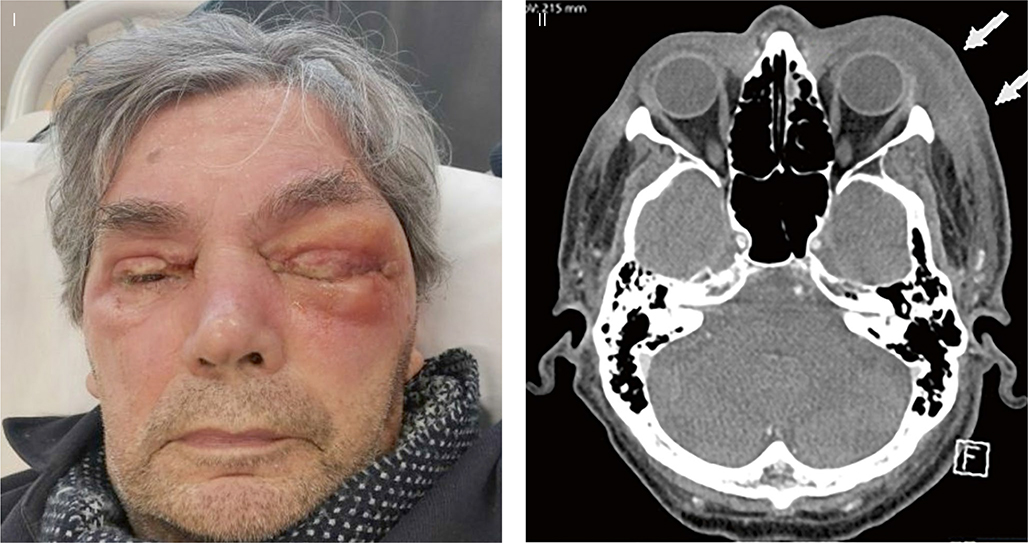 Fasciitis necroticans in het hoofd-halsgebied | H&W