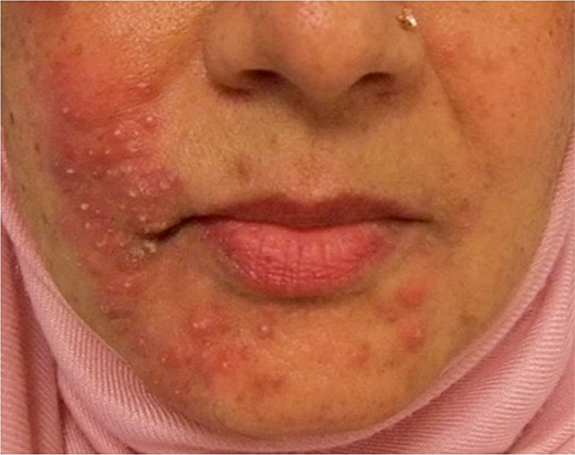 Kleurrijke dermatologie in de eerste lijn | H&W