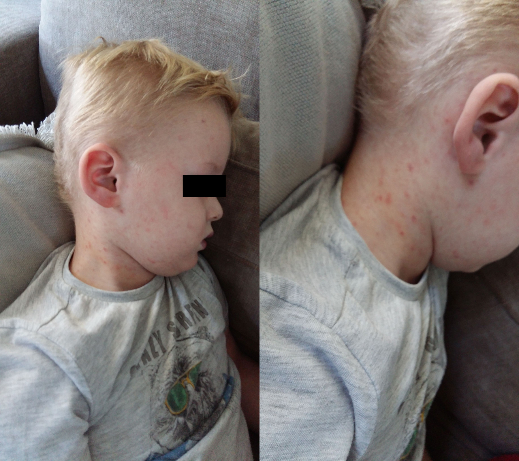 Een kind met meningokokkensepsis | Huisarts & Wetenschap