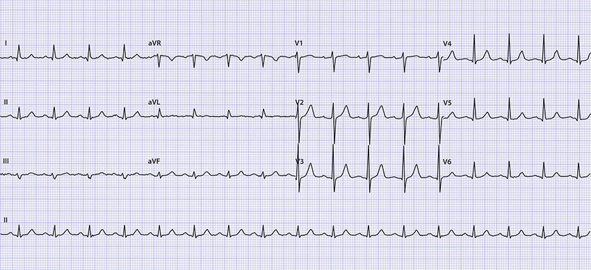 Ecg-casus 'Pleinvrees' | H&W