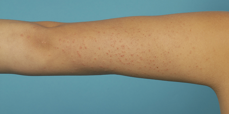 Het gianotti-crostisyndroom geneest (meestal) vanzelf | H&W