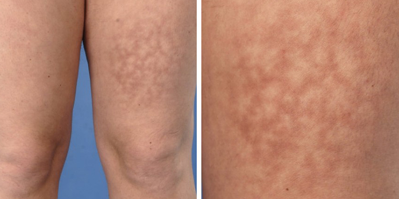 Erythema ab igne: herkenning en behandeling van ‘kachelbenen’ | H&W