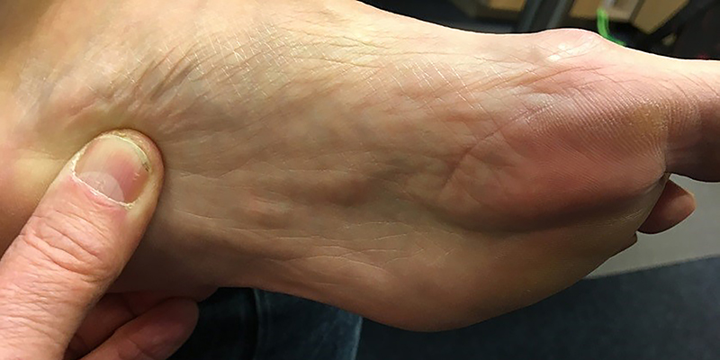 Ledderhosesyndroom of plantaire fibromatose | H&W