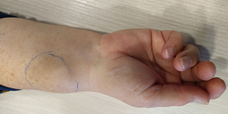 Pijnlijke zwelling van de pols | H&W