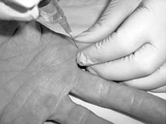 Volair blok als alternatief voor Oberst bij verdoving vinger | H&W