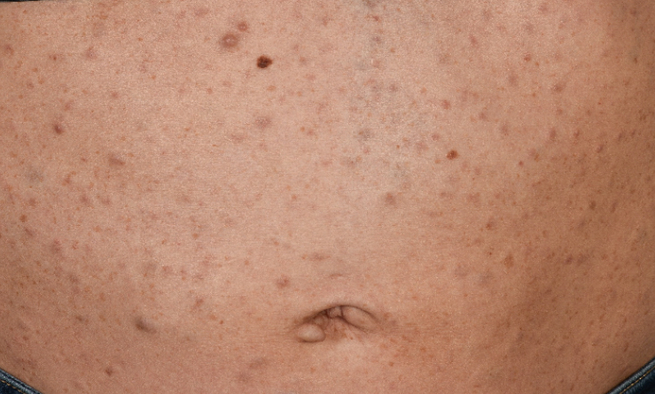 Herkenning en behandeling van neurofibromatose type 1 | H&W