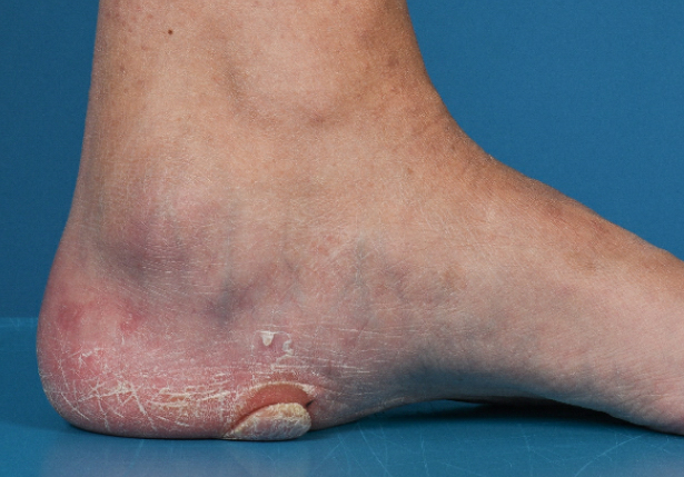 Herkenning en behandeling van neurofibromatose type 1 | H&W