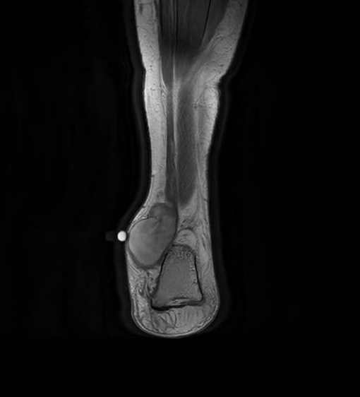 Herkenning en behandeling van neurofibromatose type 1 | H&W