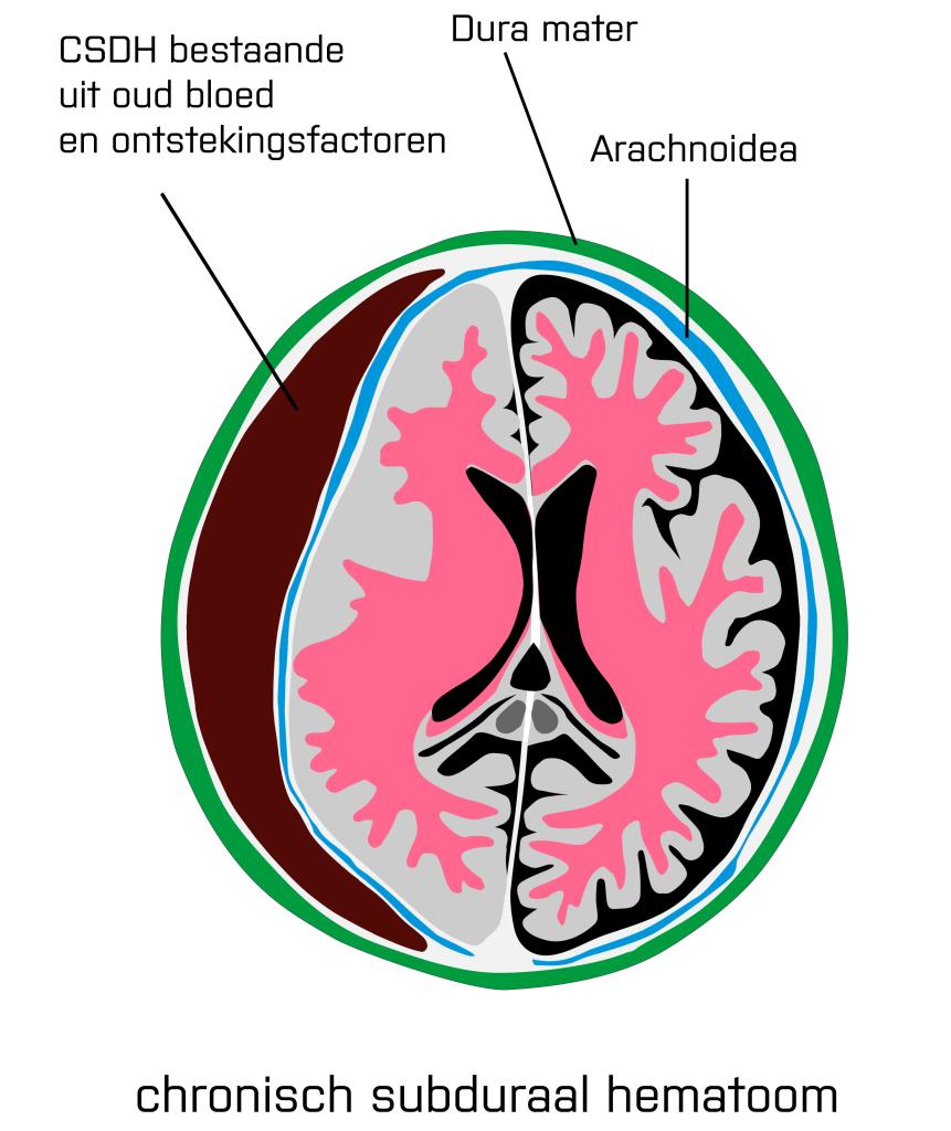 Let op late klachten na een hoofdtrauma | H&W