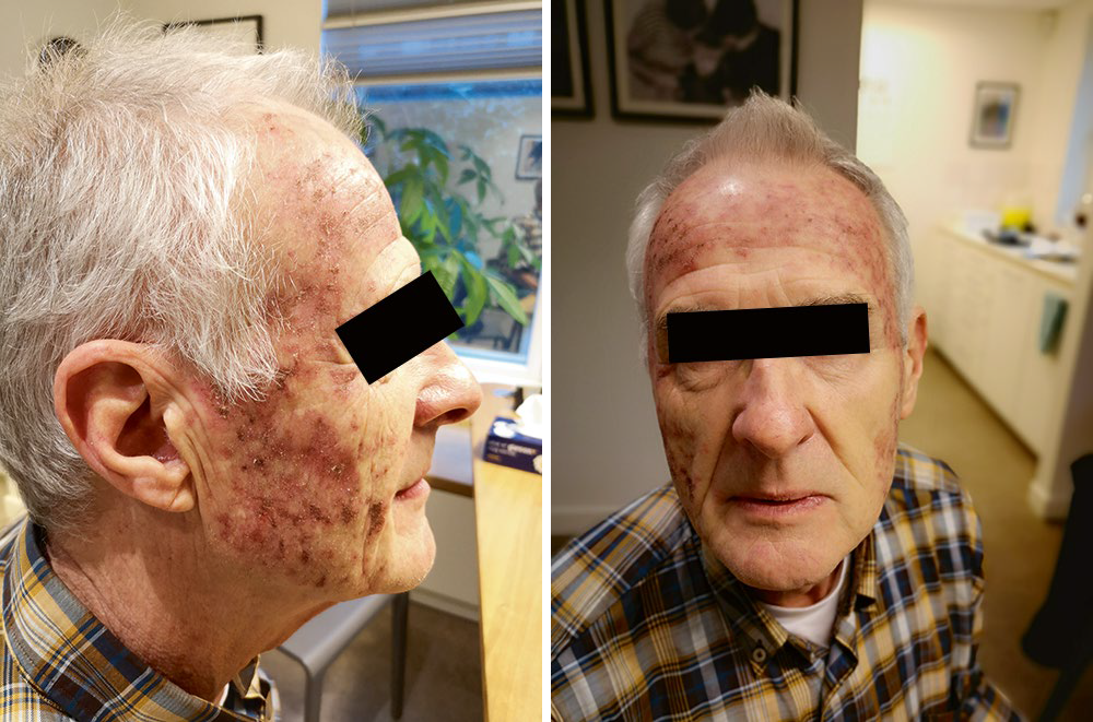 Veldbehandeling van actinische keratosen | H&W