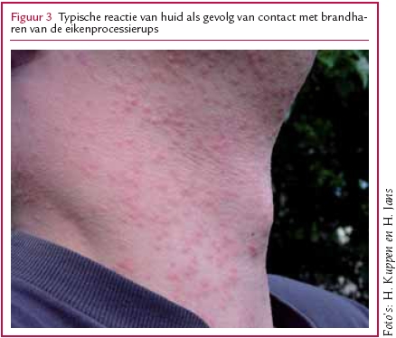 Eikenprocessierups Huiduitslag - Vermijd De Eikenprocessierups Klachten ...