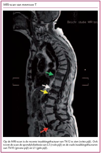 Pijn na een osteoporotische wervelfractuur | H&W