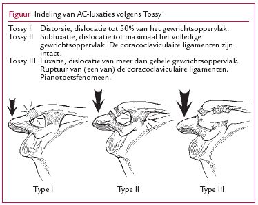 Acromioclaviculaire luxatie | H&W