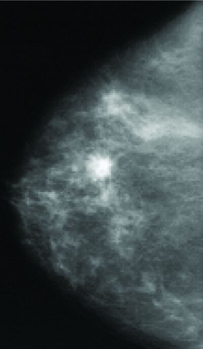 Knobbel in de borst | Huisarts & Wetenschap