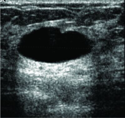 Knobbel in de borst | Huisarts & Wetenschap