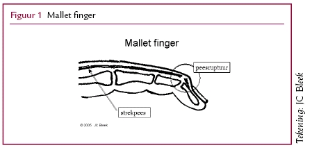 Mallet finger | H&W