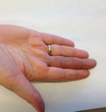 Een vijftigjarige vrouw komt op het spreekuur met een pijnlijke ...