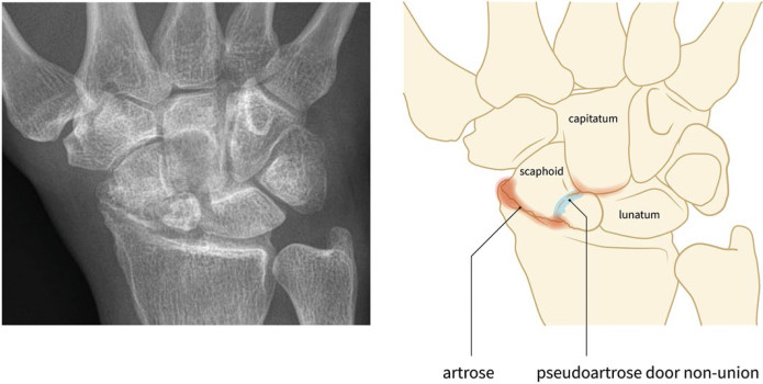 Een pijnlijke pols na een val | H&W