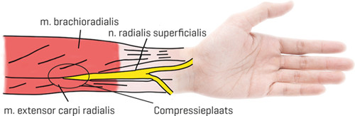Het wartenbergsyndroom | H&W
