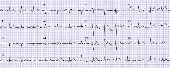 Ecg-casus ‘Hart of long?’ | H&W