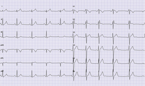 Ecg-casus ‘Hart of long?’ | H&W