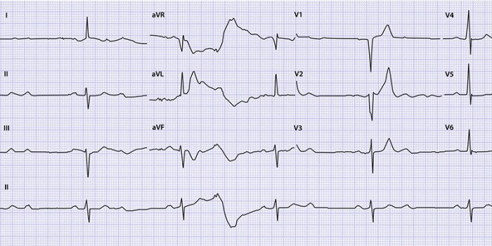 Ecg-casus ‘Op bed’ | H&W