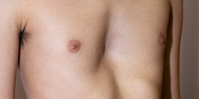 Pectusafwijkingen herkennen en behandelen | H&W