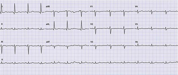 Ecg-casus ‘Slechte conditie’ | H&W
