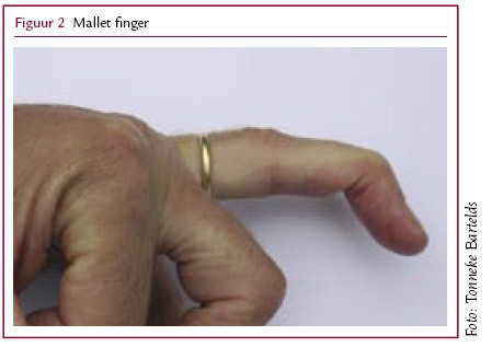 Mallet finger | H&W