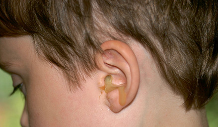 Lopend onderzoek: Orale of lokale antibiotica bij een plots ontstaan ...