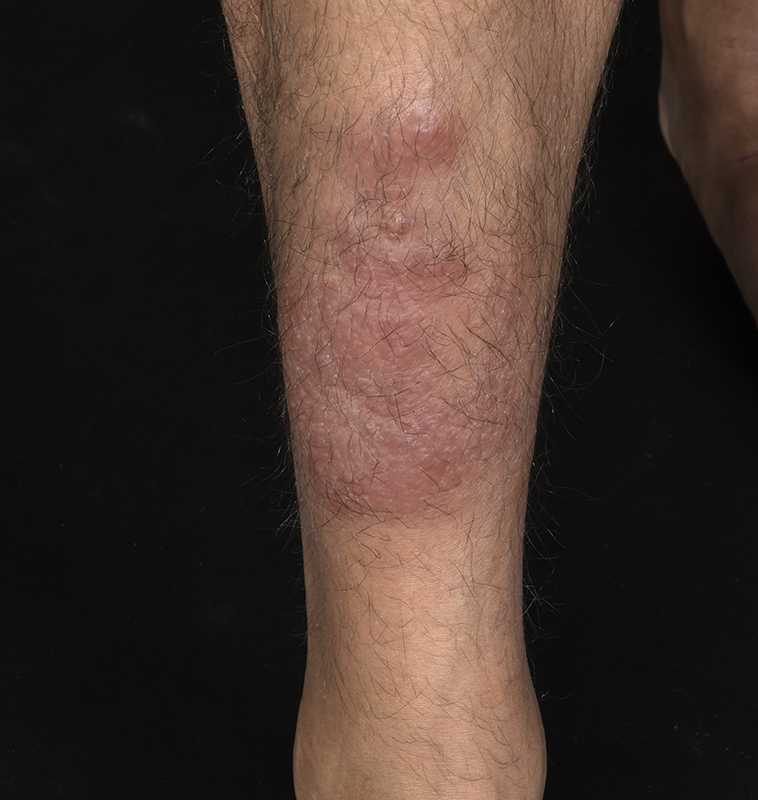 Vochtophoping op het scheenbeen | H&W